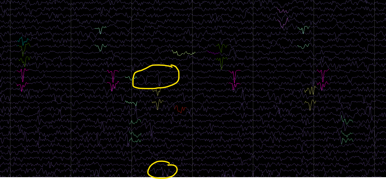 Complex spikes · Issue #536 · MouseLand/Kilosort · GitHub