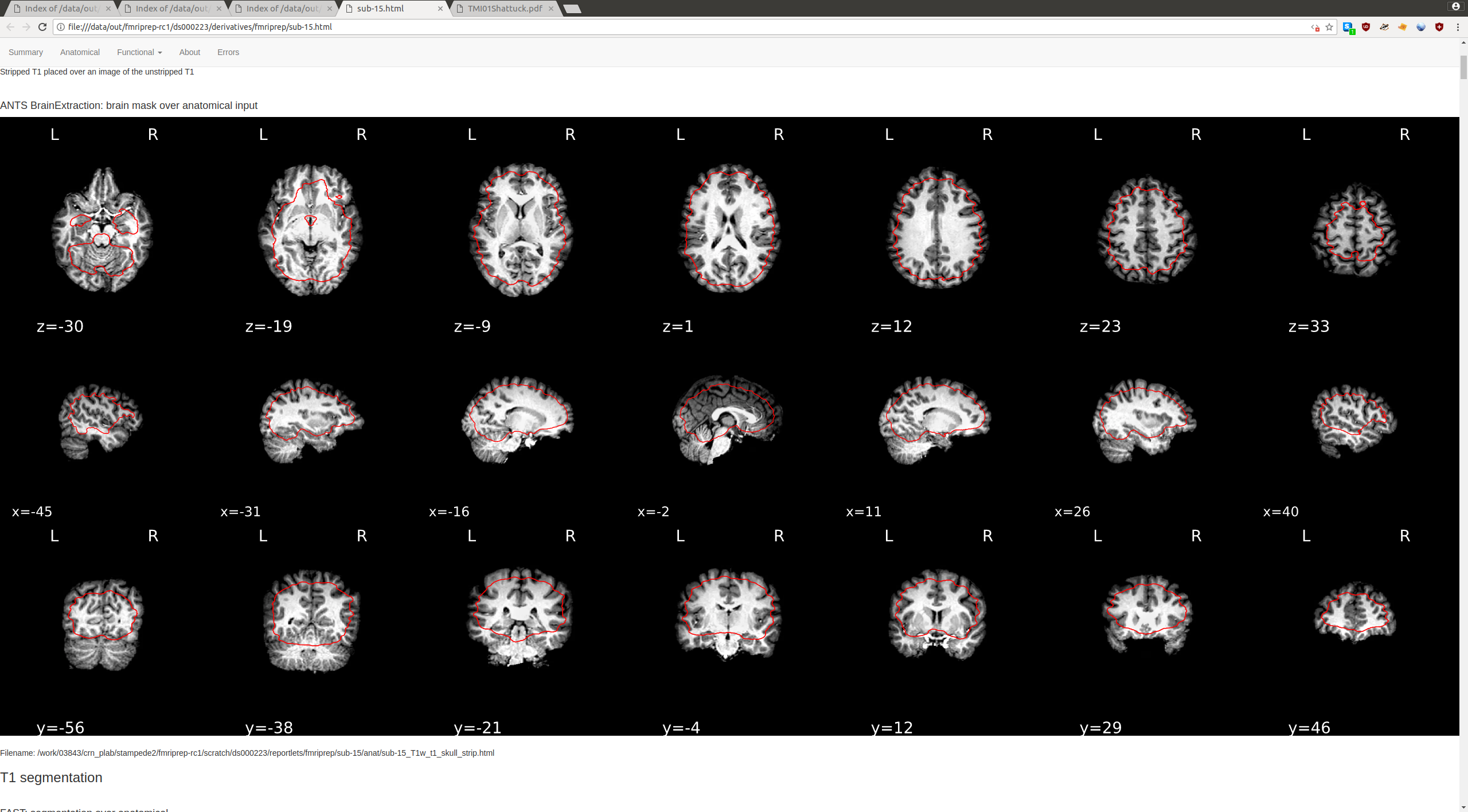 Gracefully handle pre-skull-stripped T1w images · Issue #12 · nipreps ...