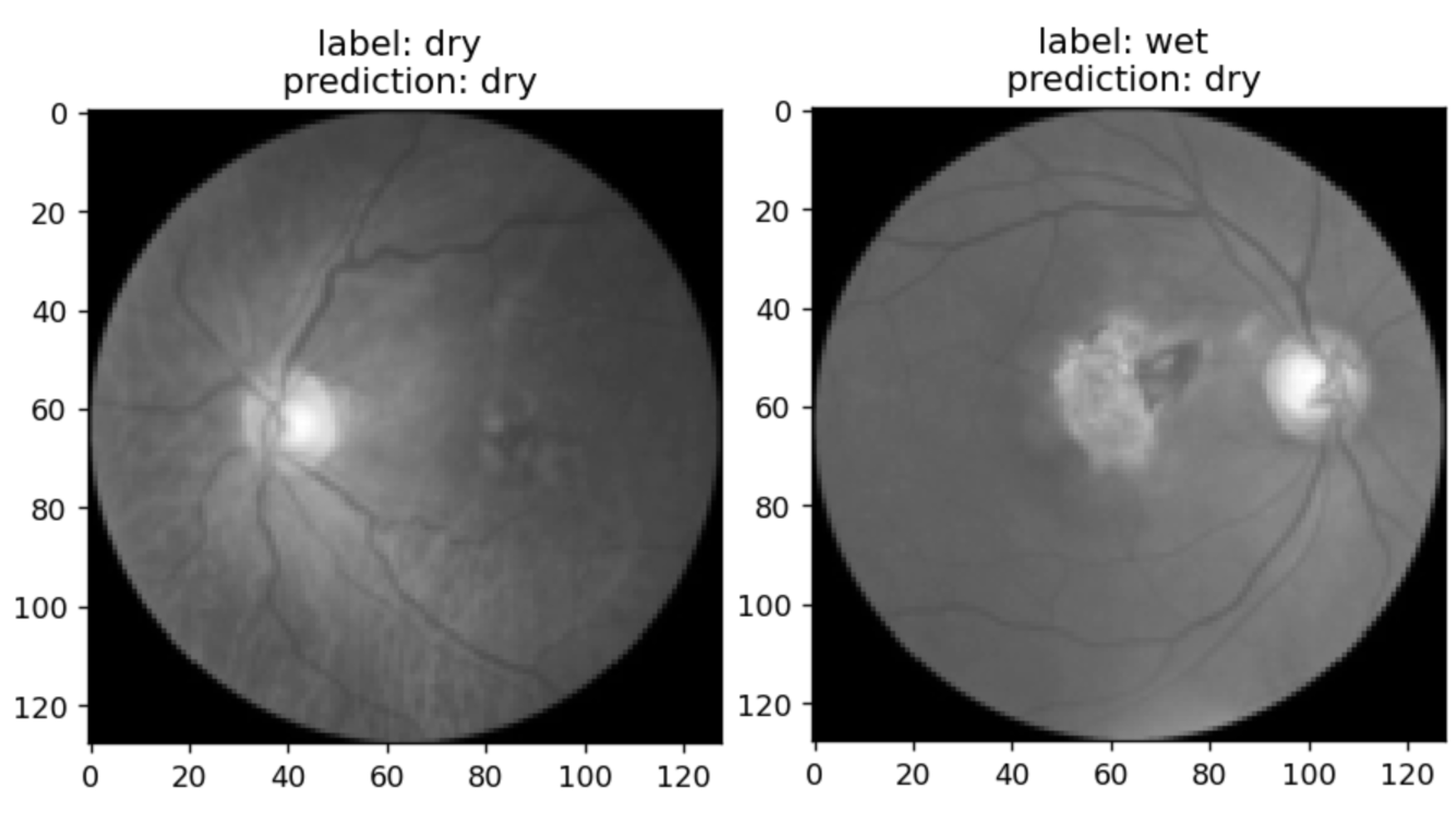 GitHub - eejj357/Diagnosis_Macular_Degeneration_With_Fundus_Images