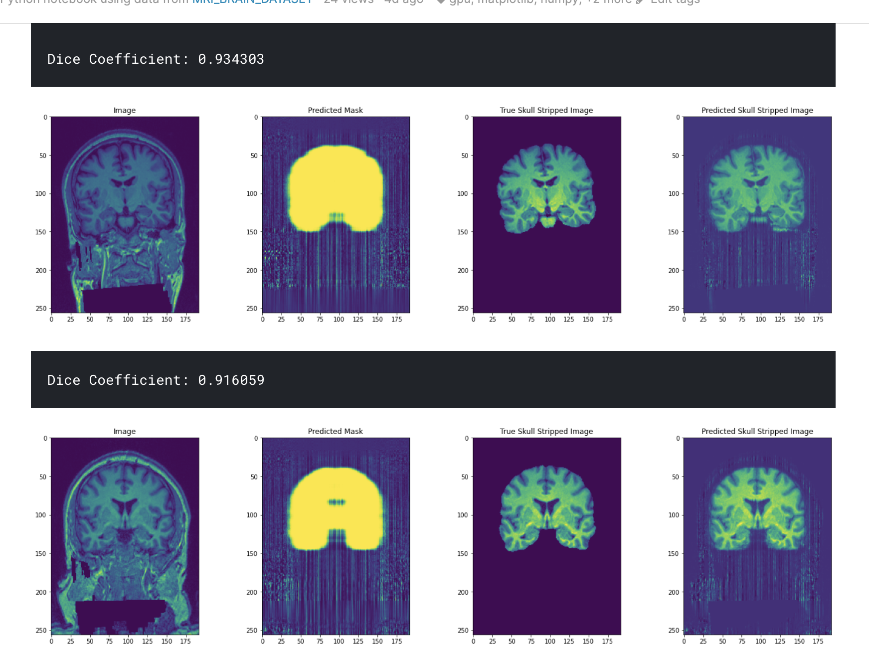 GitHub - maloyk-ai/Brain-Skull-Segmentation: Skull Stripping of MRI images using UNet
