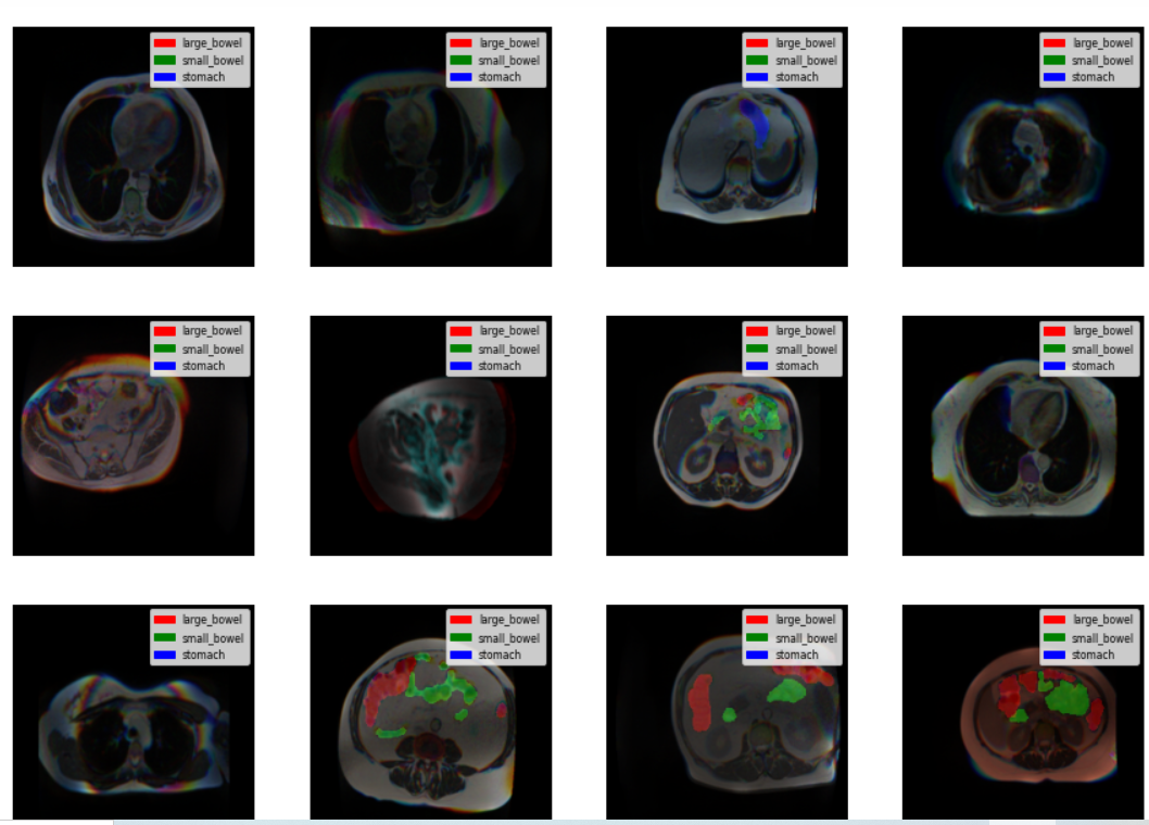 GitHub - DrGrenkenstien/GI-Segmentation