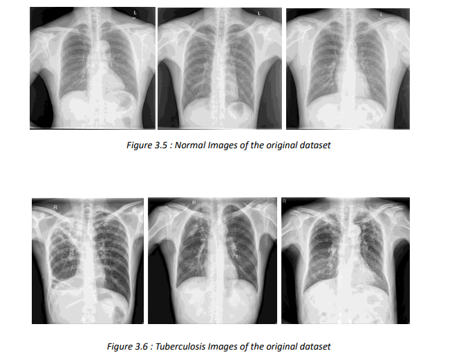 GitHub - Sadeepi/Pulmonary_Tuberculosis-_desease-detection