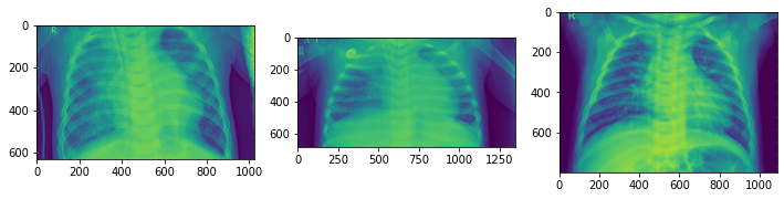 GitHub - JohatTech/Pneumonia-Detection-with-CNN-arquitecture-with ...