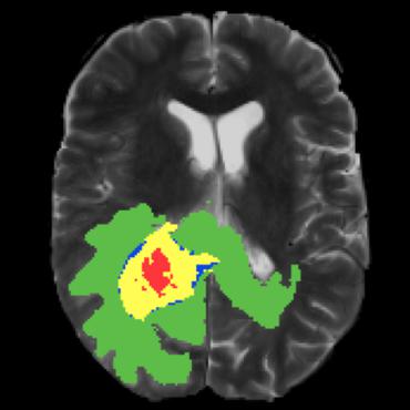GitHub - Noman-Nosher/Brain-Tumor-Detection-using-Deep-learning ...