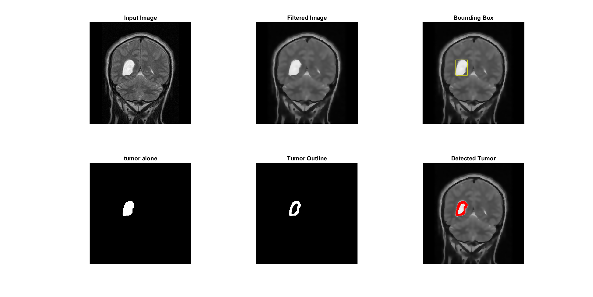 GitHub - ZarinMADHIHA/Brain-Tumour-Detection