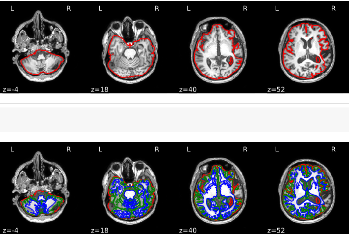 Weird brain masks · Issue #768 · nipreps/mriqc · GitHub