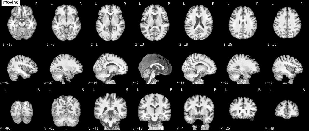 Spatial normalization and skull stripping failure on T1w images · Issue ...
