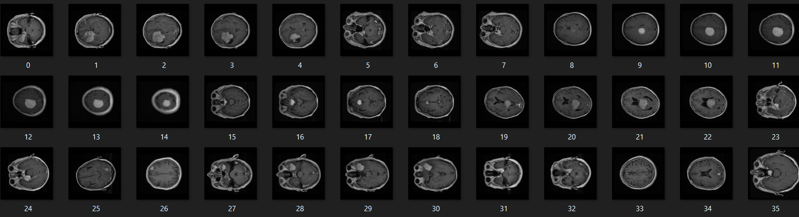GitHub - Harmandeep-Kaur123/Brain_tumor-segmentation: It is a medical image analysis task that ...