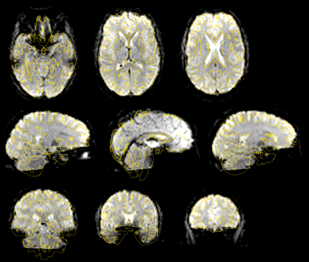 Show edges for overlays · Issue #78 · niivue/niivue · GitHub