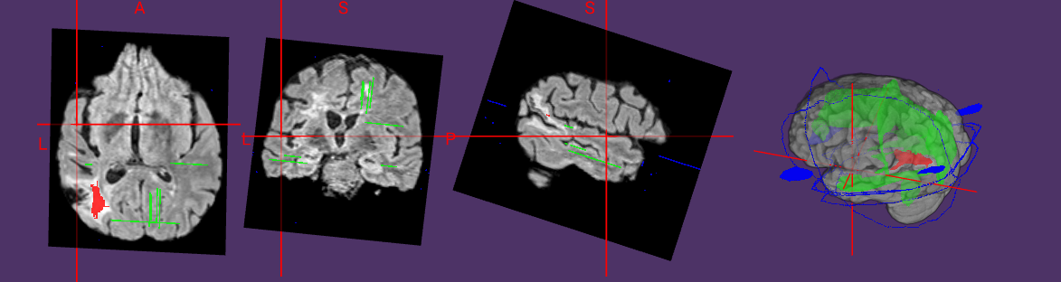 drawings do not appear in 3D render · Issue #339 · niivue/niivue · GitHub