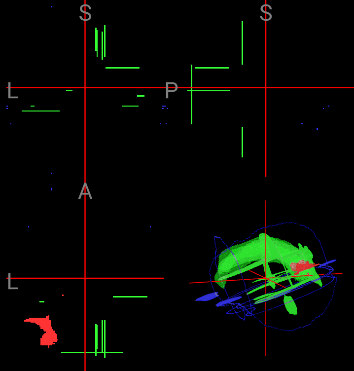 area and angle measurement · Issue #595 · niivue/niivue · GitHub