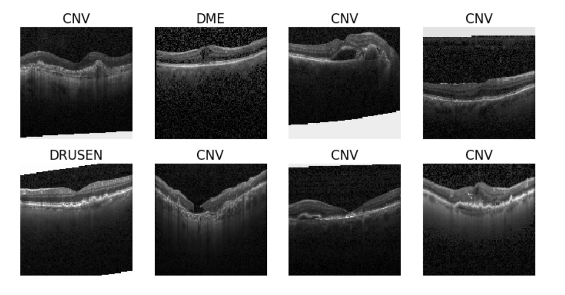 GitHub - AnilpreetSingh/OCT-classification: Diabetic Macular Edema is the major cause of vision ...