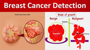 GitHub - Poojayadav25/Breast-Cancer-Detection-using-Machine-Learning-Classifier