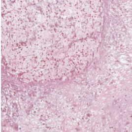 GitHub - Subliminated/Cancer-Image-recognition