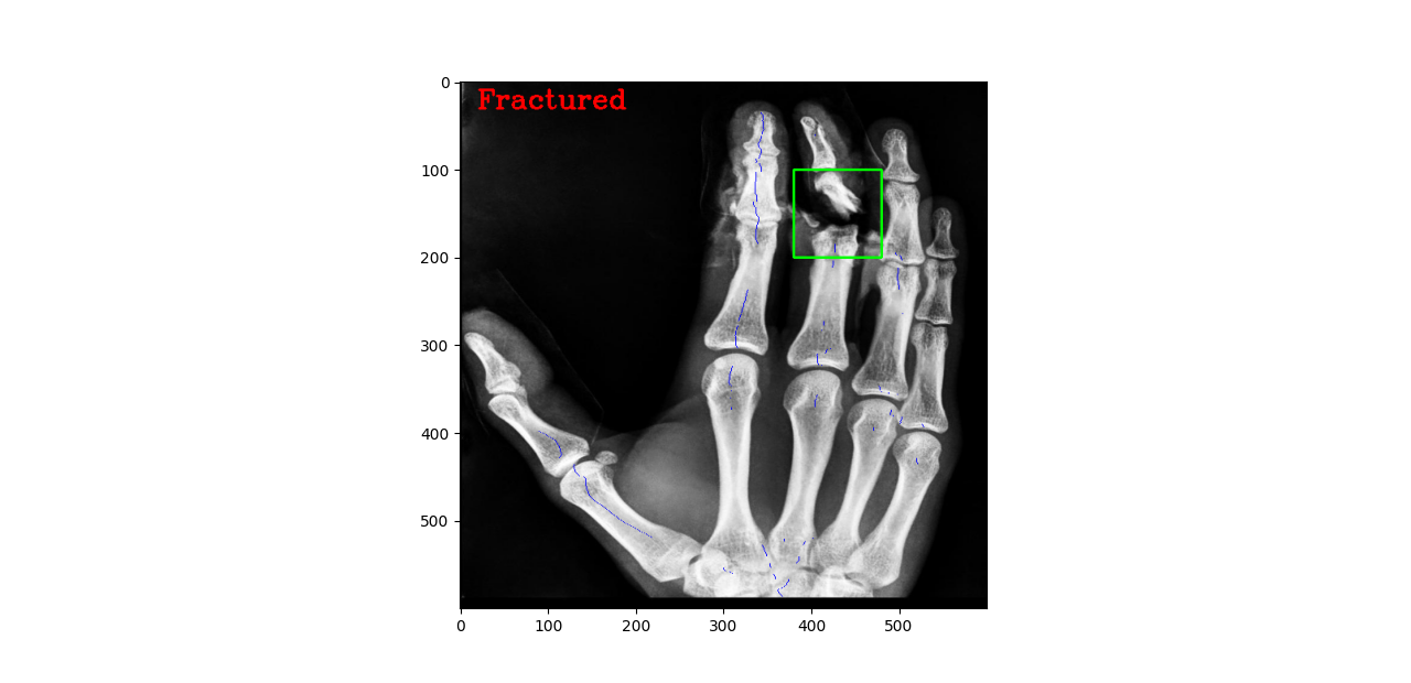 Github Therushikale Bone Fratcture Detection Using Opencv