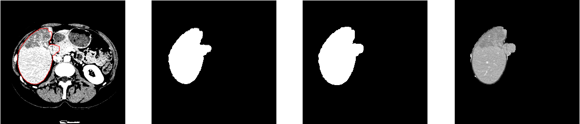 GitHub - zahrakhoshdel/Automated-Liver-Tumor-Detection: a computer ...