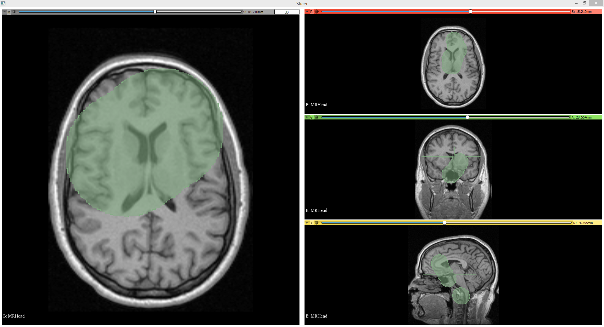Streamline segmentation interface · Issue #2 · HOA-2/SlicerNeuroSegmentation · GitHub