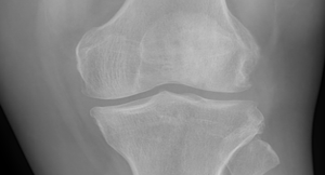 Github Vinit Changawala Osteoarthritis Classification Using Deep