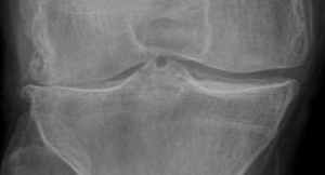Github Vinit Changawala Osteoarthritis Classification Using Deep