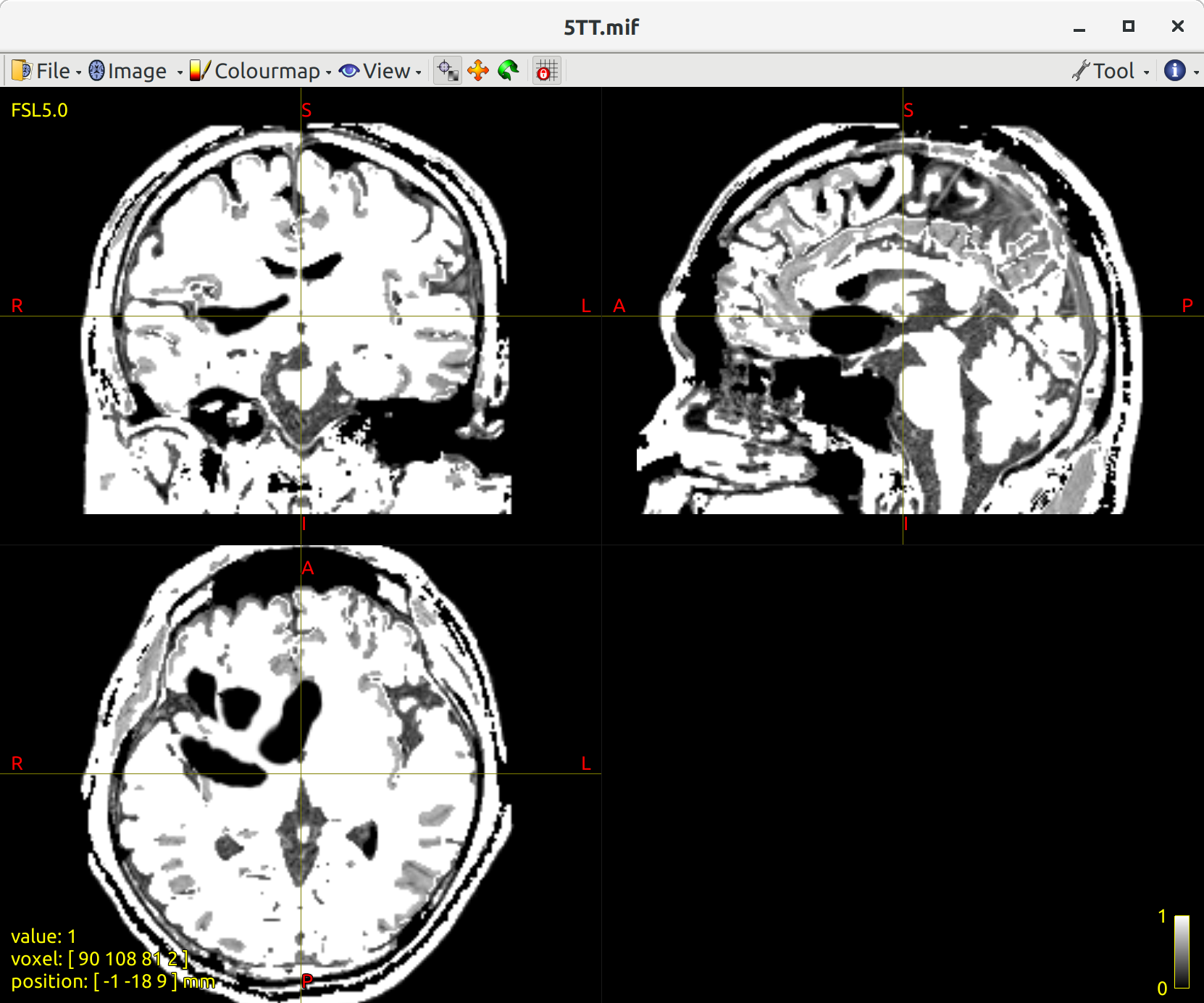 IndexError: index -2 is out of bounds for axis 0 with size 1 · Issue #80 · MIC-DKFZ/TractSeg ...