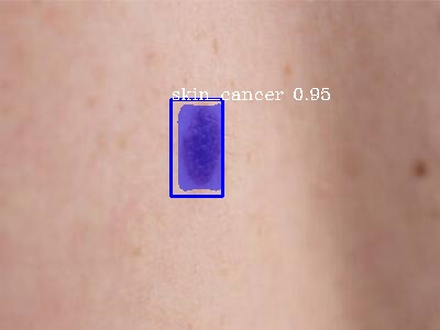 GitHub - w412k/Skin-cancer-detection: Skin cancer detection / deep ...