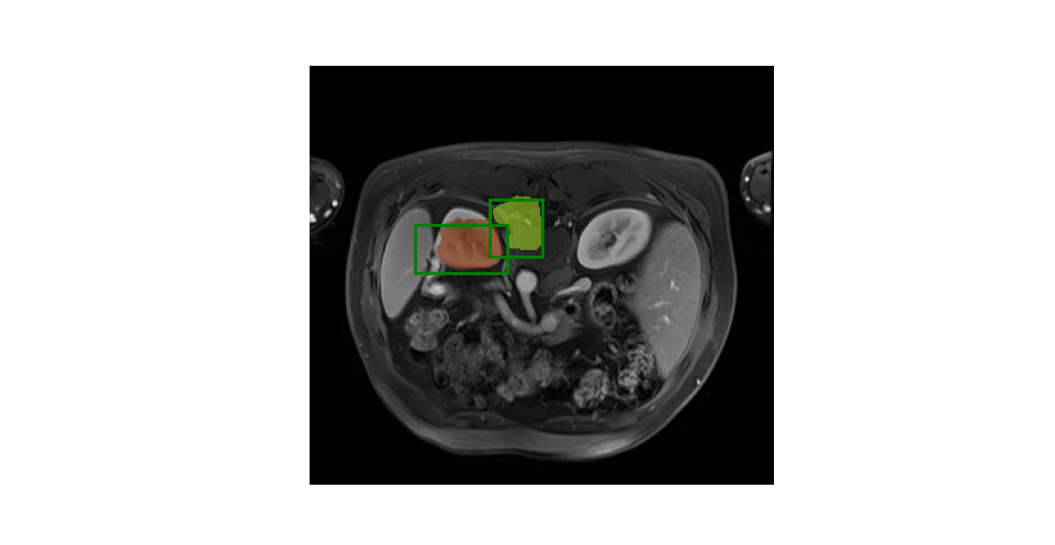 Bad case · Issue #1 · OpenGVLab/SAM-Med2D · GitHub