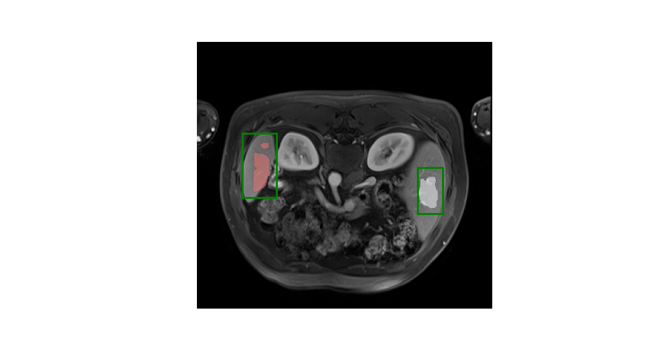 Bad case · Issue #1 · OpenGVLab/SAM-Med2D · GitHub