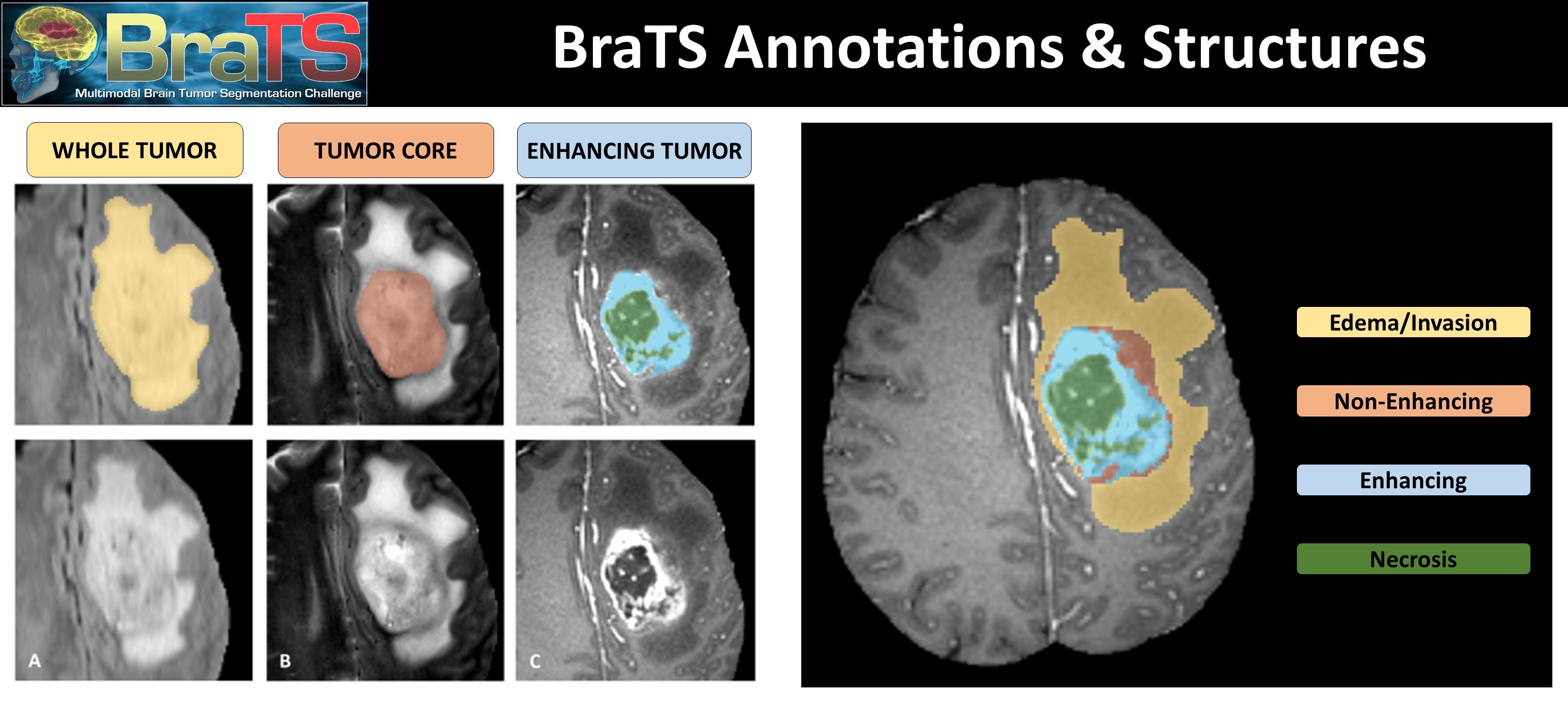 GitHub - Oumaimabel/Deep-Learning-Segmentation-Brain-Cancer
