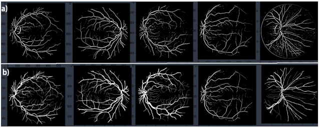 GitHub - bduartee/Automatic-Segmentation-of-Vessels-Retinas-in-Eye ...