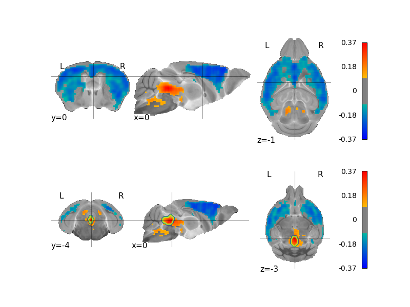 Make statistic map plots share colorbar · Issue #1464 · nilearn/nilearn ...