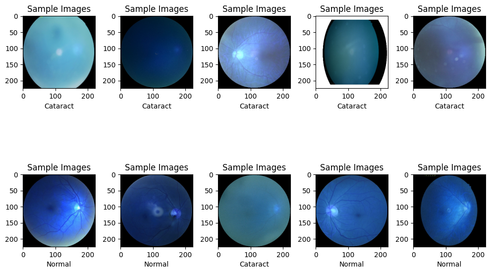 Github Jigarsiddhpura Cataract Detection