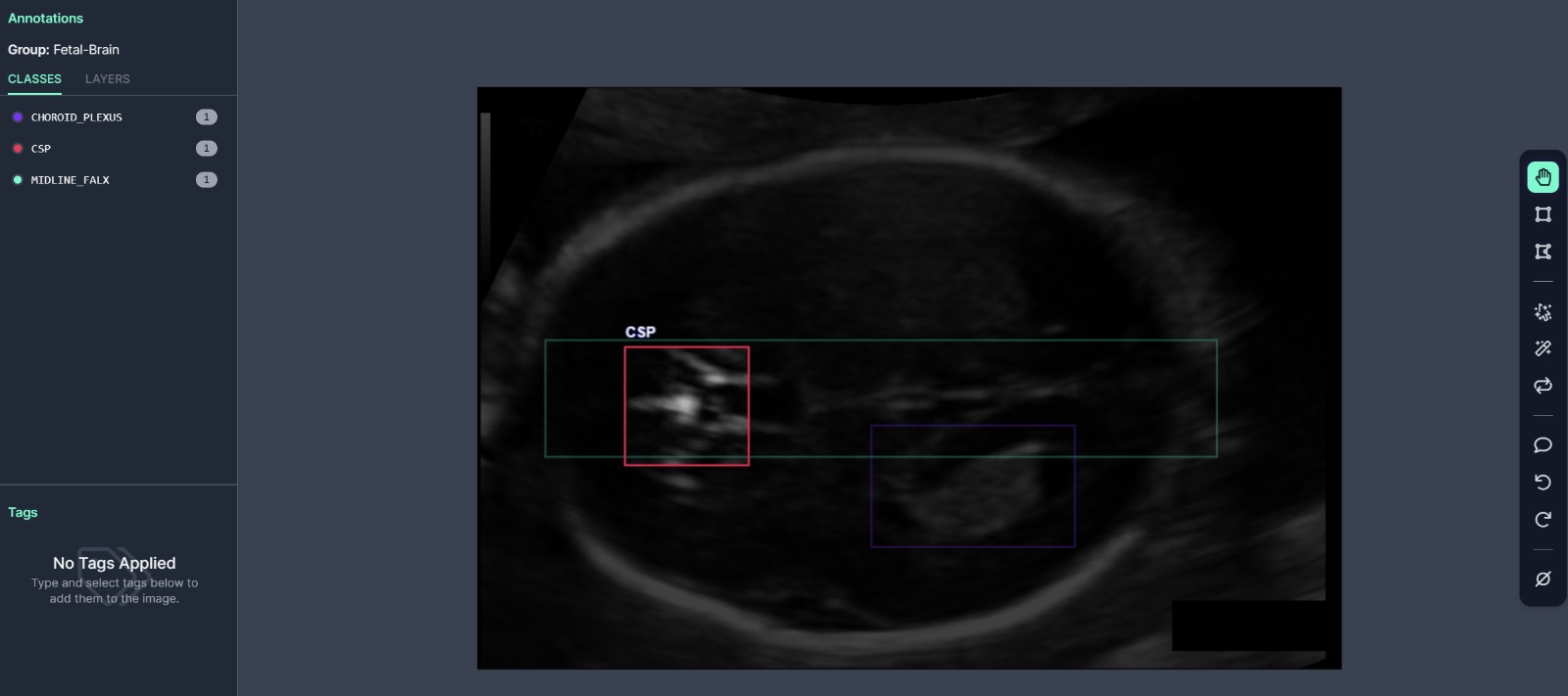 GitHub - FozanAzhar/Ultrasound-Fetal-CNS-Anomaly-Detection