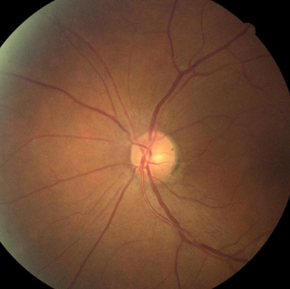 GitHub - ahmedaliziada/Glaucoma-Detection