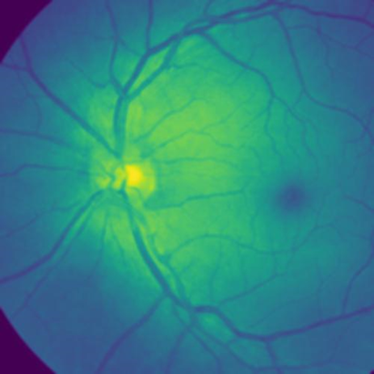 GitHub - ahmedaliziada/Glaucoma-Detection