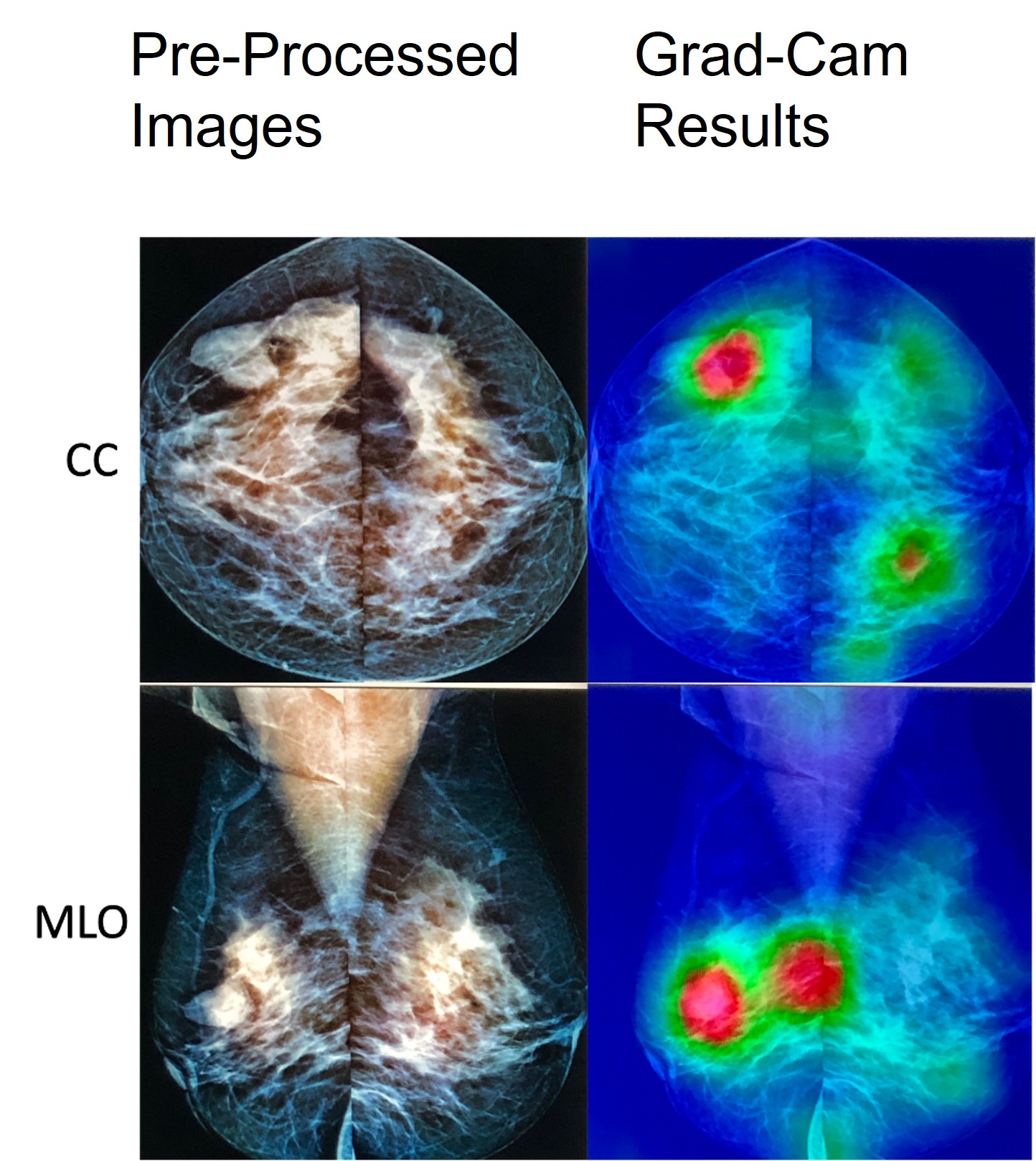 GitHub - omerfarukdinc/mamographyai: Mamographyai can predict different ...
