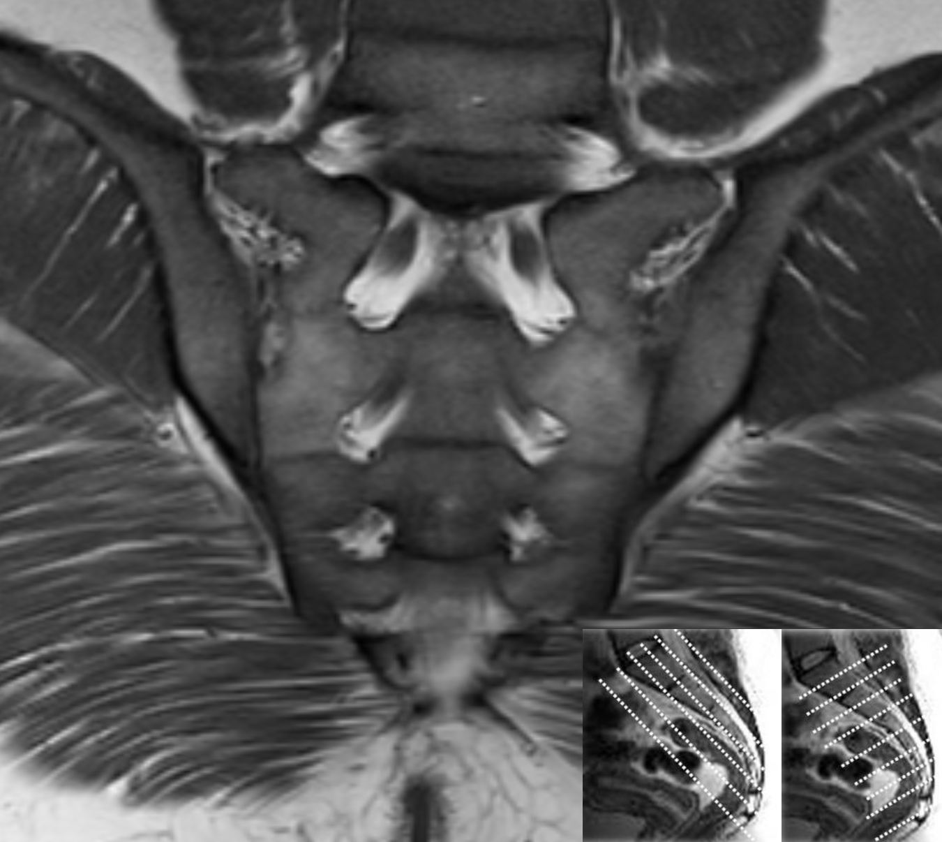 sacrum coronal · Issue #7 · TechnicalMSK/MSK-MRI · GitHub