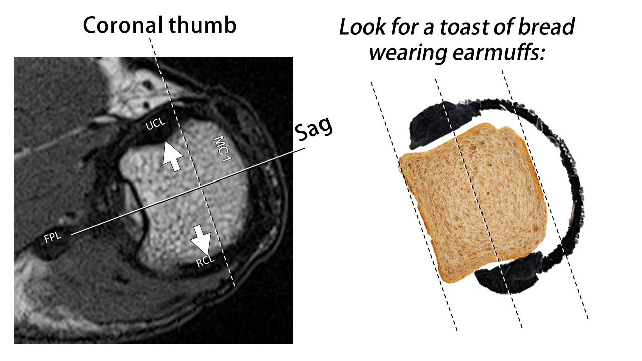 thumb prescription · Issue #10 · TechnicalMSK/MSK-MRI · GitHub