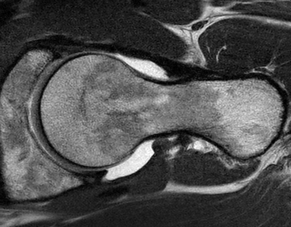 MR Arthrography hip axial oblique · Issue #11 · TechnicalMSK/MSK-MRI ...