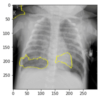 GitHub - vq7484/Explainable-AI-for-Pneumonia-Classification
