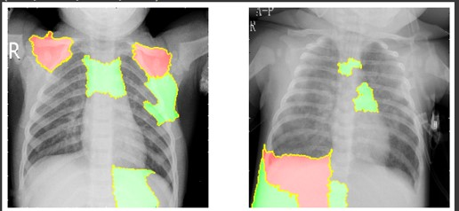GitHub - vq7484/Explainable-AI-for-Pneumonia-Classification