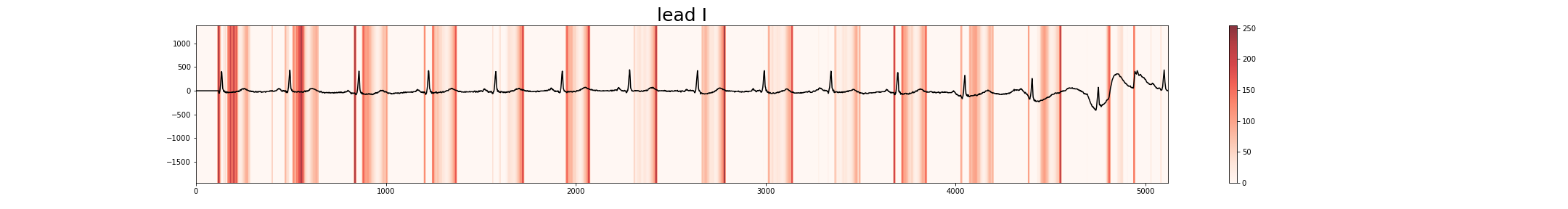 GitHub - dr-you-group/PROPHECY-STEMI: deep learning algorithm to classify patients with STEMI or ...