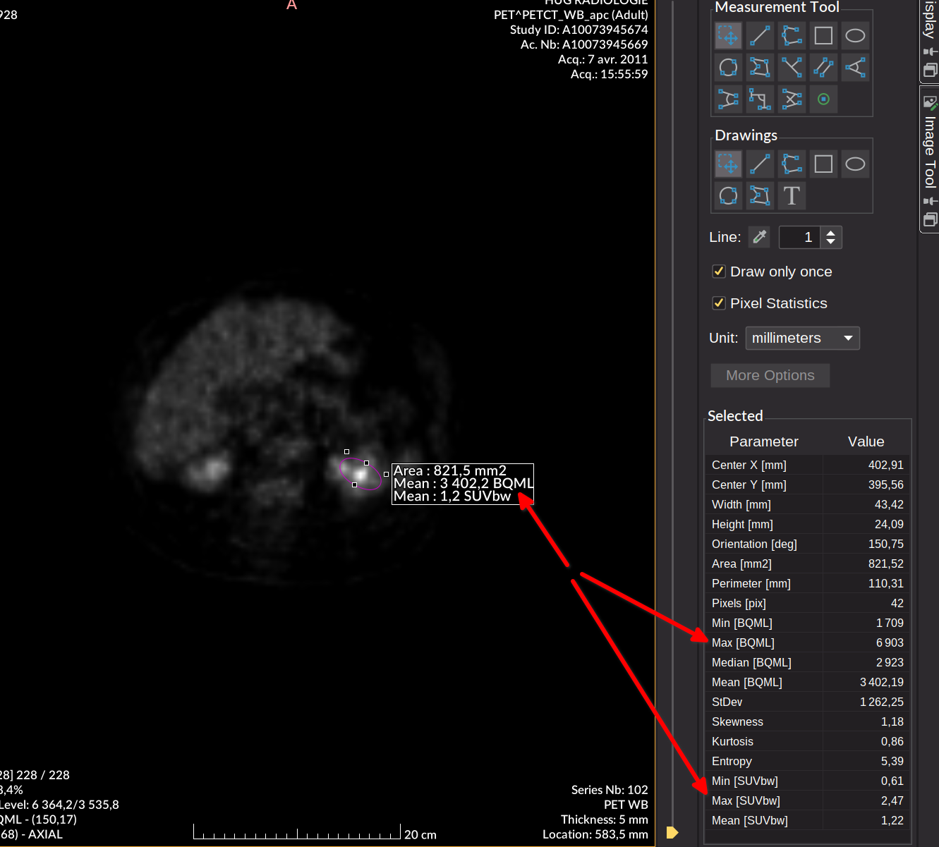 SUV measurement · Issue #244 · nroduit/Weasis · GitHub