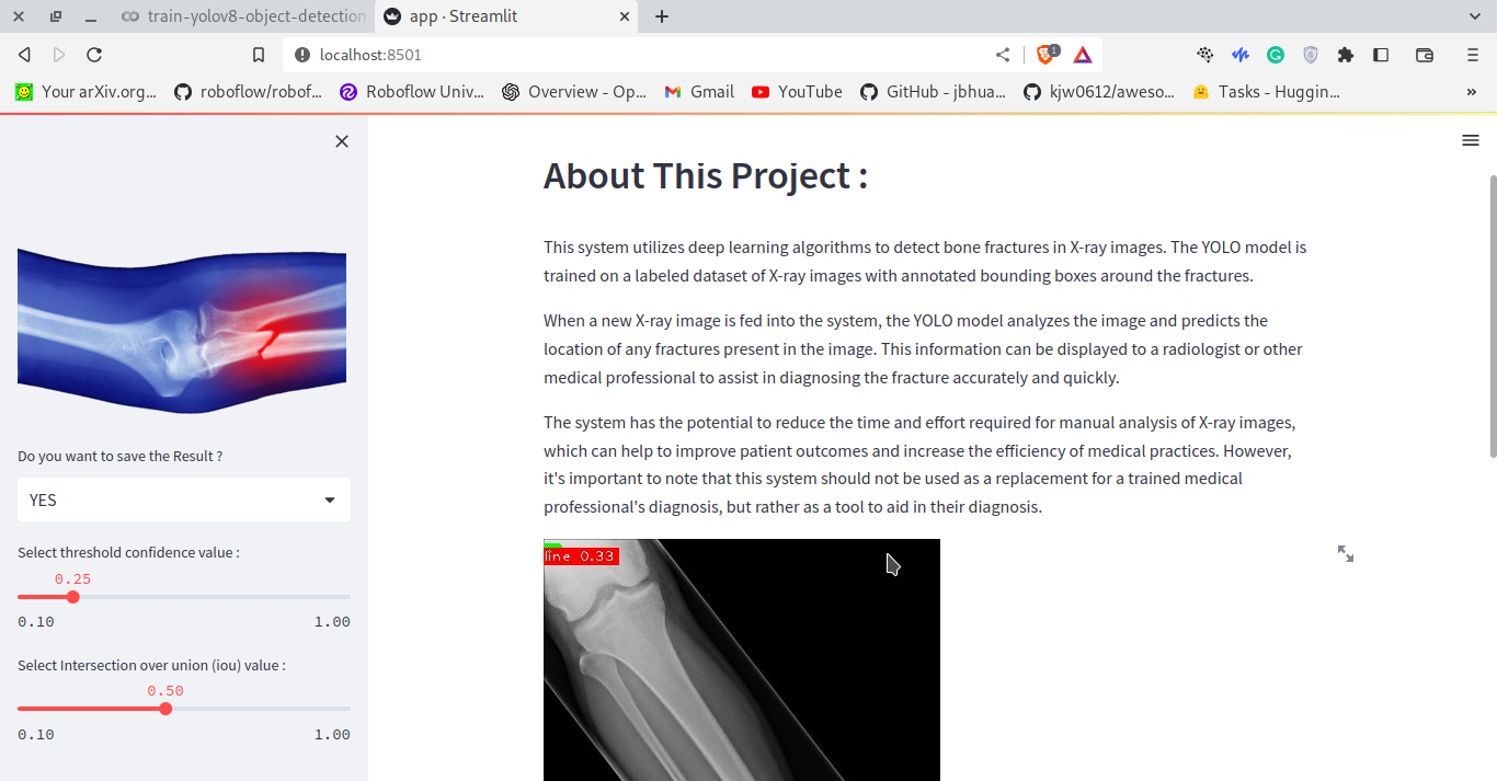 Github Kirouane Ayoub Bone Fracture Detection